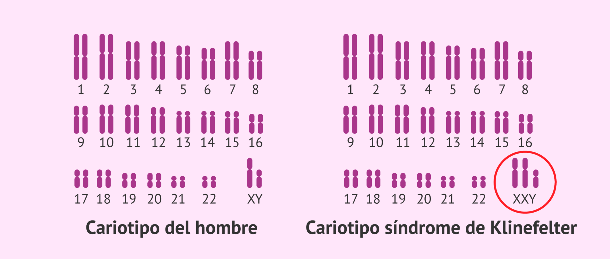 Síndrome de Klinefelter